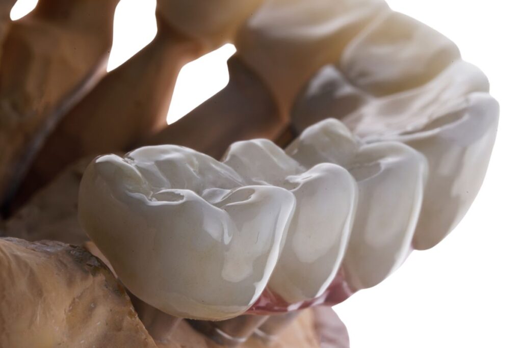 Root Canal vs. Dental Crown: Which Is Best? - Alvarez Family Dentistry