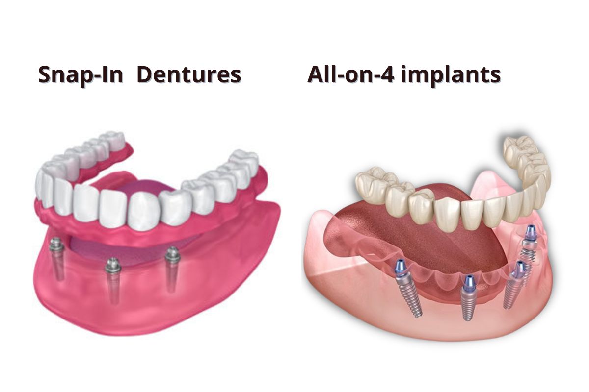 How Do Snap-on Dentures Compare to All-on-4 Implants