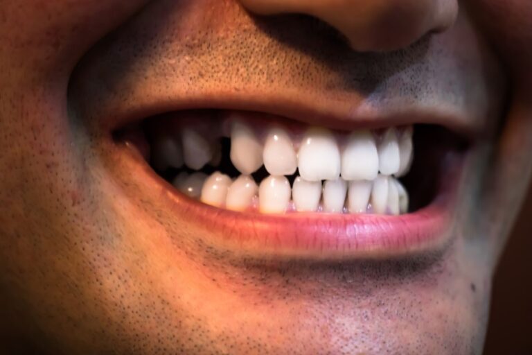 Dental Implants Explained: Crowns, Bridges & Full Arch Fixed Teeth